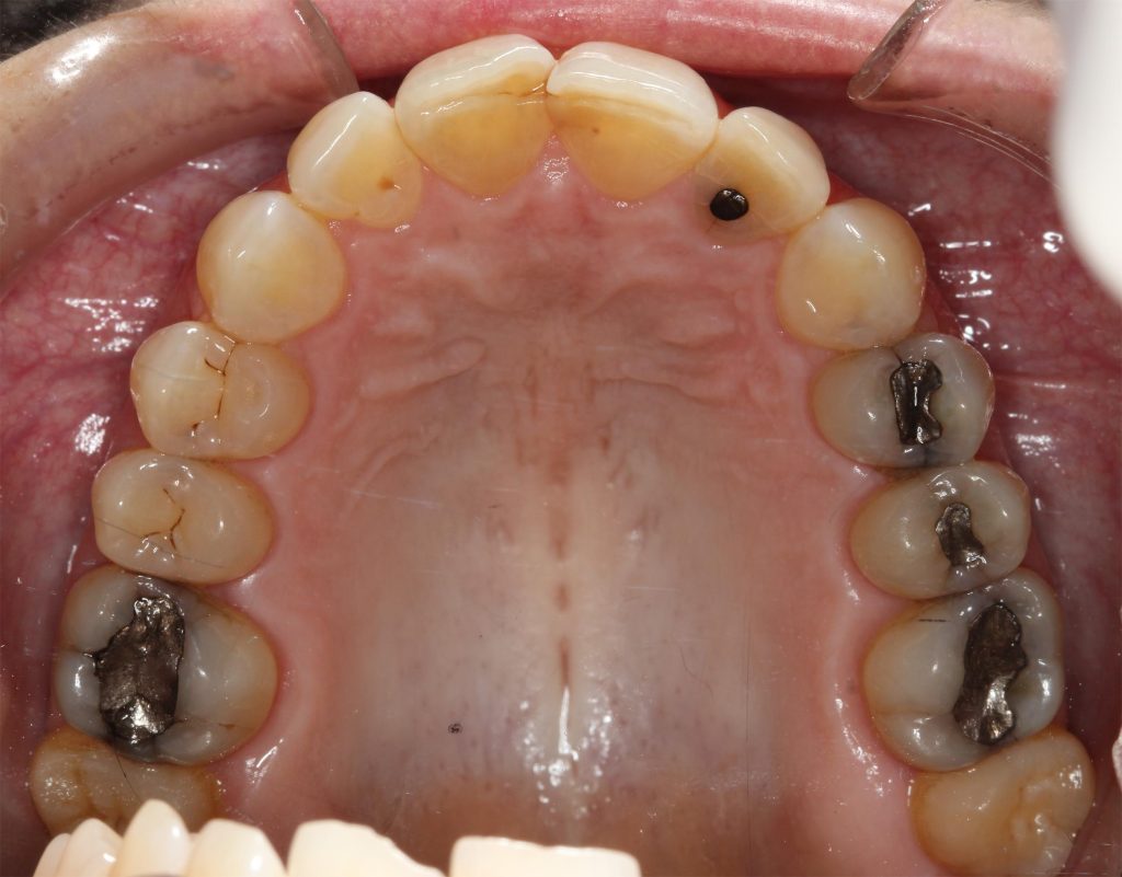 Te ayudamos a eliminar tus amalgamas dentales de forma segura | KIMO ...